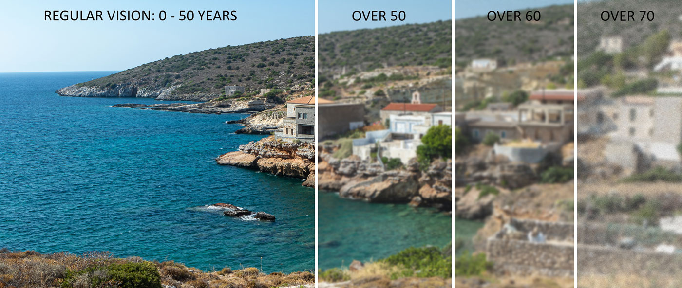 Cataracts in Los Angeles | Barry Seibel, MD | Seibel Vision Surgery